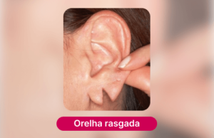 Tipos de Orelhas e Suas Deformidades | Doutor Orelhinha
